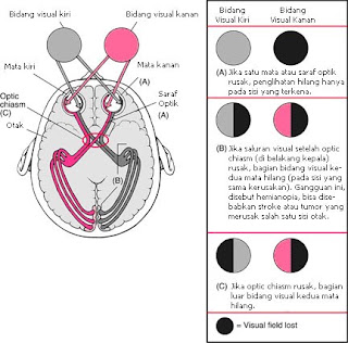 Kesehatan Milik Semua: Gangguan Saraf Optik