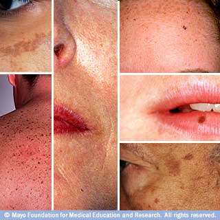 Healthy Life: Skin problems (2) : Sun Damage