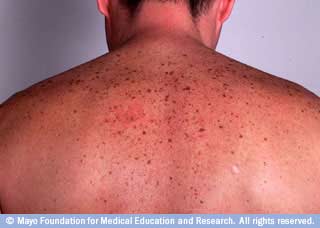 Healthy Life: Skin problems (2) : Sun Damage