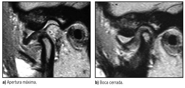El blog de radio: Estudio(paper) de Resonancia Magnética en las ATM