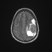 Rob's Radiology: Pleomorphic Xanthoastrocytoma