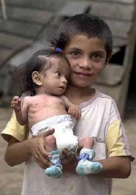 Madre de Dios, Región de la Biodiversidad Peruana: Desnutrición