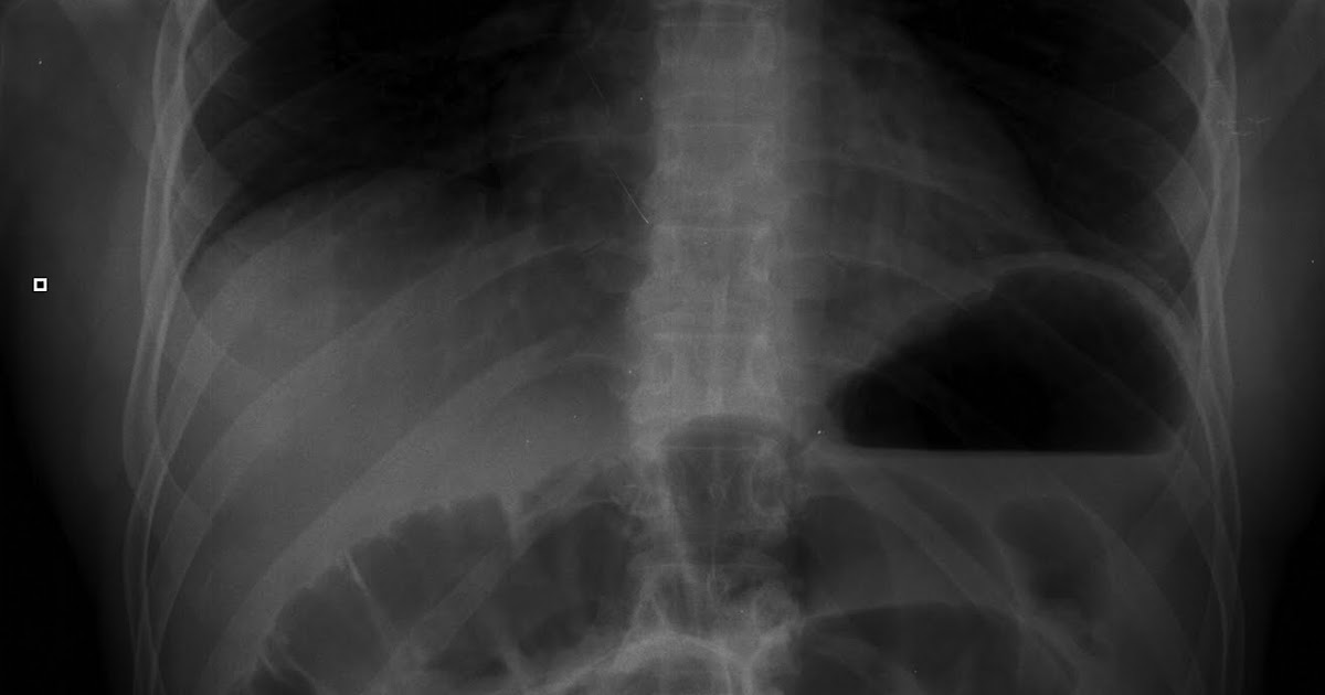 MEDICINA INTERNA: Asas Intestinales Dilatadas y Ptosis Palpebral.