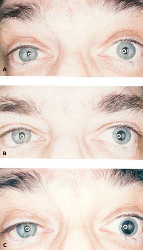 ENTORNO MÉDICO: Sindrome de Horner