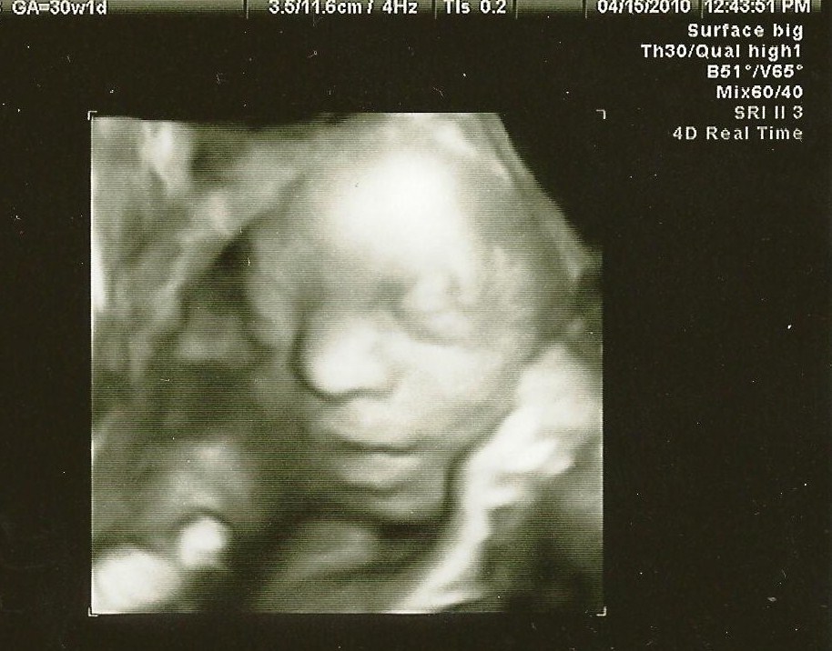 Seeking Sunshine: 30 week ultrasound