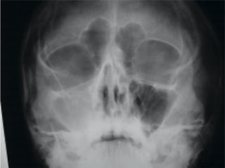 Nurses Care: Sinusite/Rinossinusite