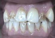 Stained teeth - types and causes | Beauty and Personal Grooming