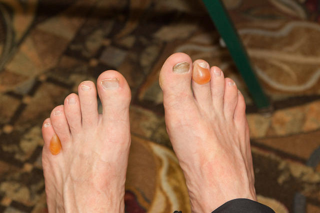 Just Go For A Ride...any ride: Frostbite.