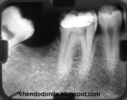 VH Endodontia: 18/04/10 - 25/04/10