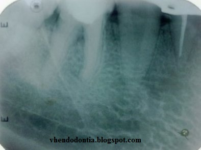 VH Endodontics: Radiographic Apex X Anatomy Apex