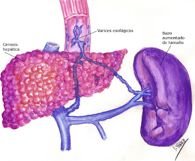 Varices esofágicas sangrantes