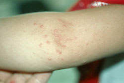 Viriasis exantemáticas