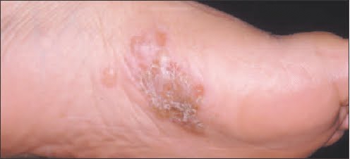 Blacksburg Virginia Foot Doctor: Tinea Pedis