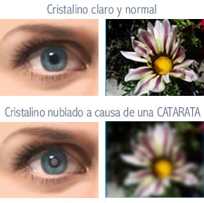 Visión Borrosa o Nublada: Catarata | CARRIAZO CENTRO OFTALMOLÓGICO