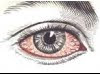 Conjuntivitis: LA CONJUNTIVITIS HEMORRAGICA AGUDA