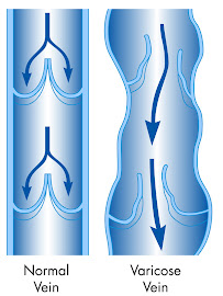 Dr. Víctor Villota Mendieta: INSUFICIENCIA VENOSA CRÒNICA