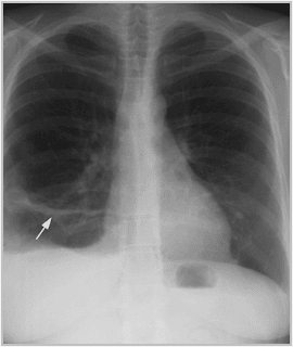 Embolia Pulmonar: EMBOLIA PULMONAR