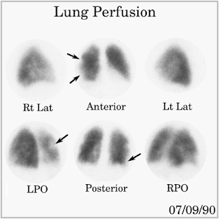 Embolia Pulmonar: EMBOLIA PULMONAR