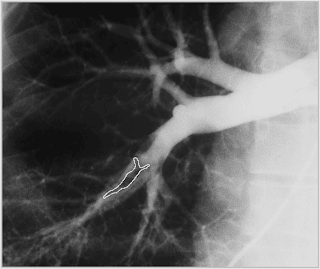 Embolia Pulmonar: EMBOLIA PULMONAR
