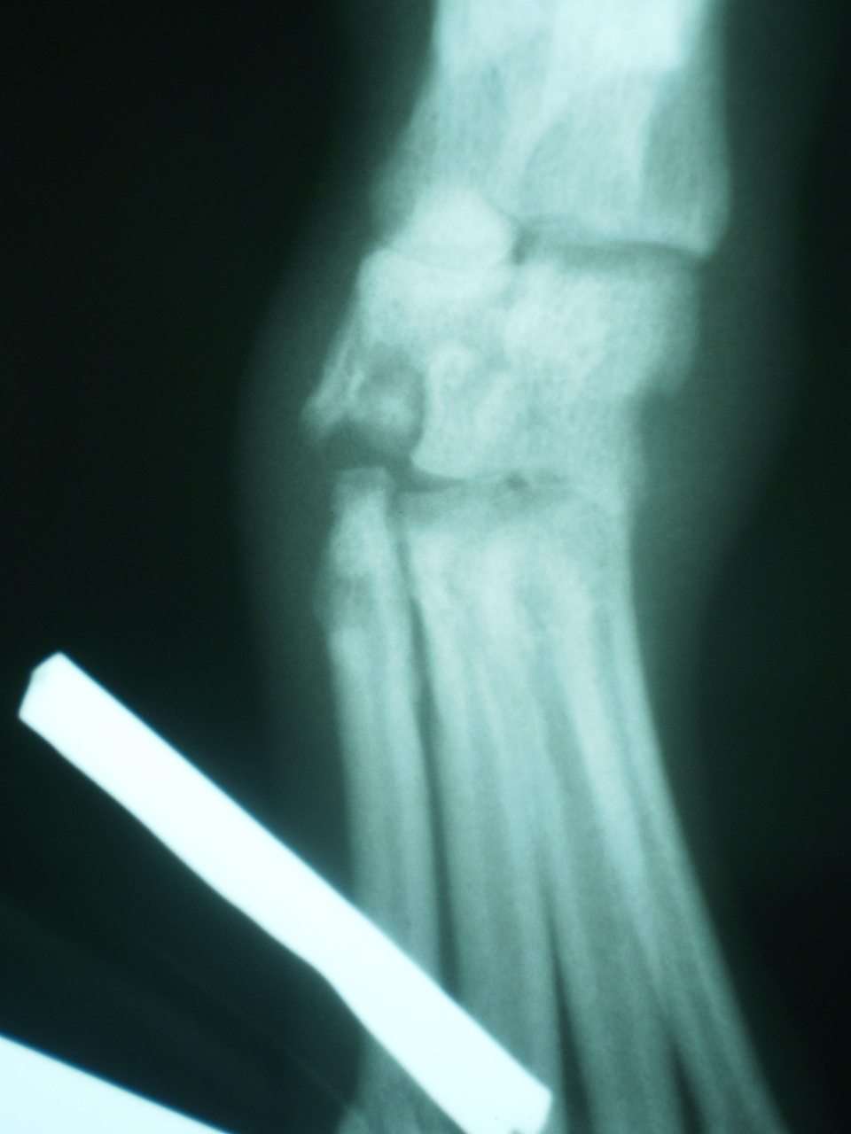 Traumatologia y Cirugia Ortopedica Veterinaria: ARTRODESIS PARCIAL DE TARSO