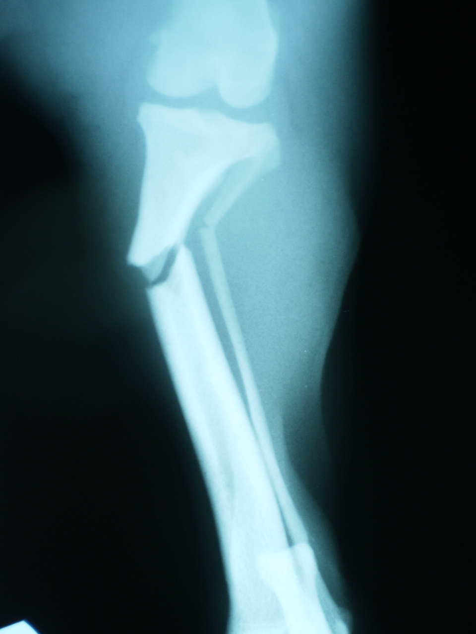 Fracturas de la tibia