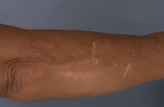 Case of the Day: Scar (Not Eschar)