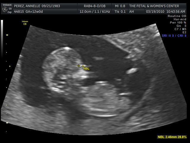 I'm going to be a Mommy!: 13 week Ultrasound Pictures