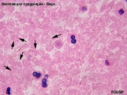 Patologia - Fisioterapia: Necrose