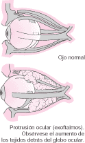 Venciendo al exoftalmos