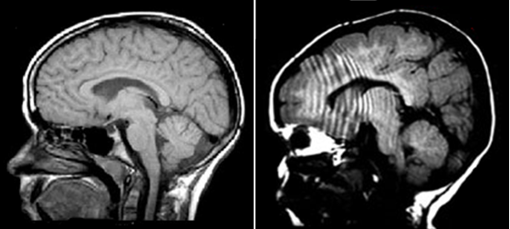 :::intoxicated colourfully:::: The Neurophysiological Effect of Alcohol ...
