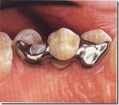 les bridges collés ~ LES COURS DENTAIRE