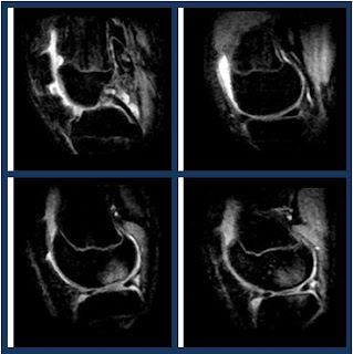 Técnicas Radiológicas y Avances: Resonancia Magnética de la Rodilla