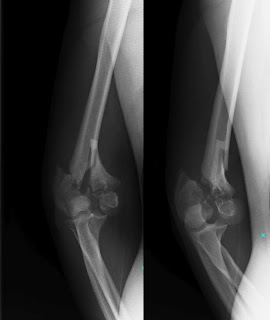 Técnicas Radiológicas y Avances: FRACTURAS