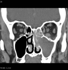 Sinusitis Understood: Imaging in the Diagnosis of Sinusitis