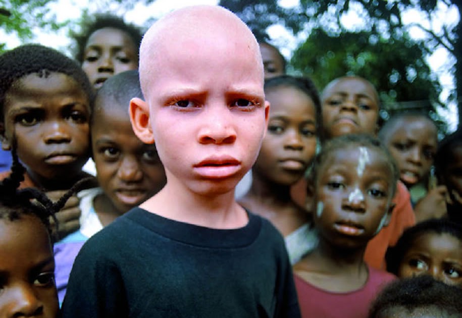 A vida dos negros albinos na África - Castro Digital | Bacabal - MA