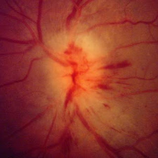 Enfermedades del nervio óptico: Neuropatía óptica isquémica