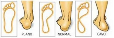 Educación Física en la Red: Pie normal, plano y cavo.