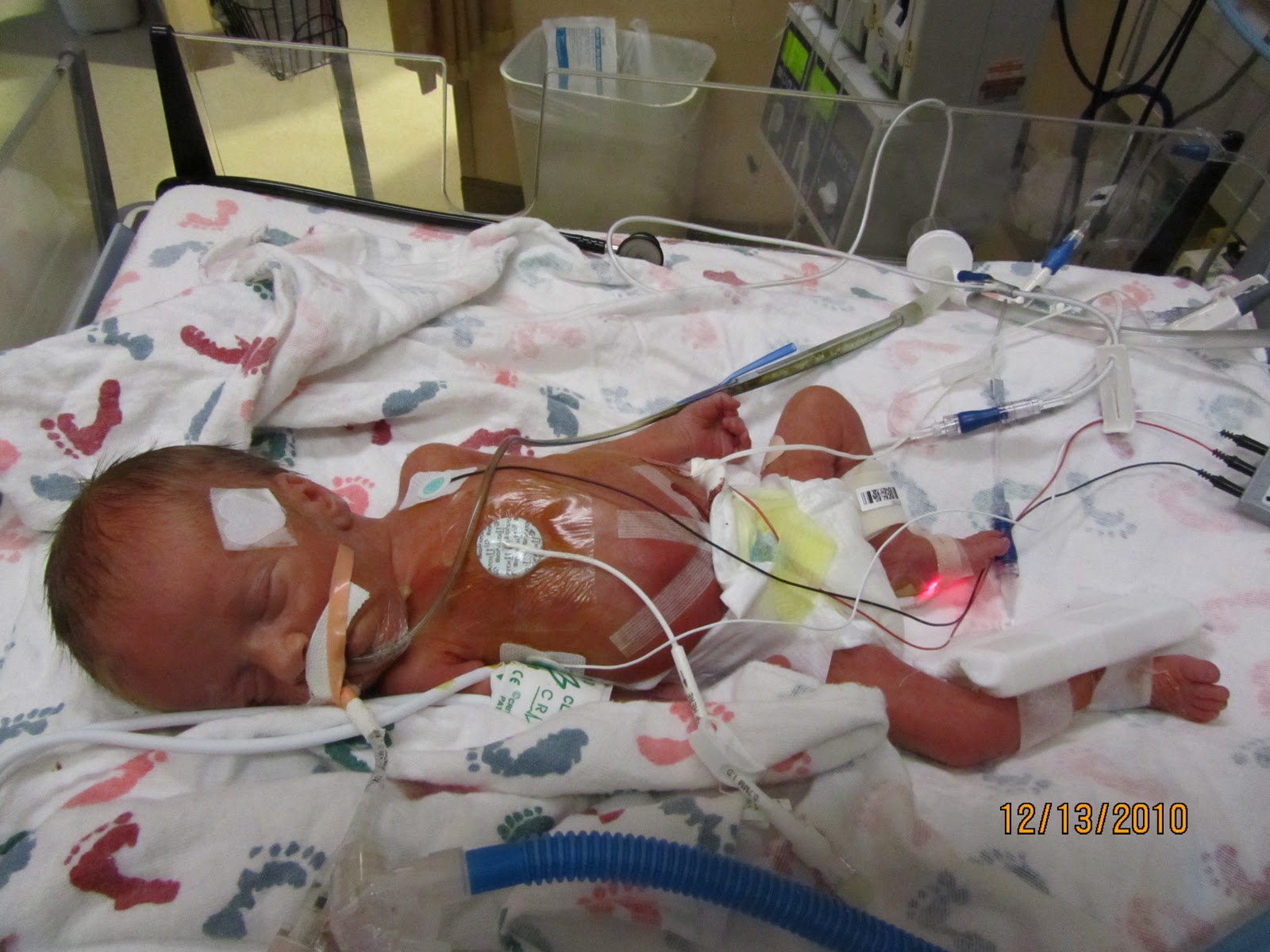 Jacob's Page: 5 days old Primary Closure surgery today and Broviac ...