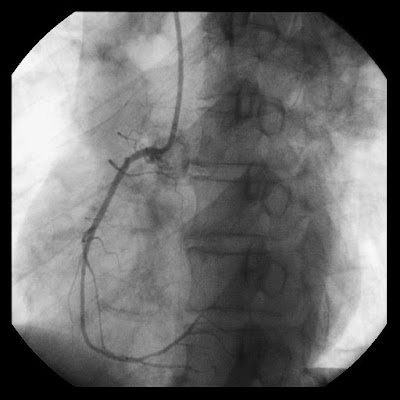 Concerning Heart: TRANSRADIAL PRIMARY PTCA TO RCA