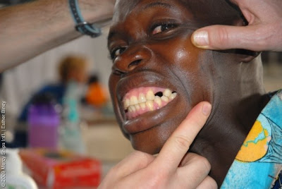 A is for Africa: Case Study: Lockjaw