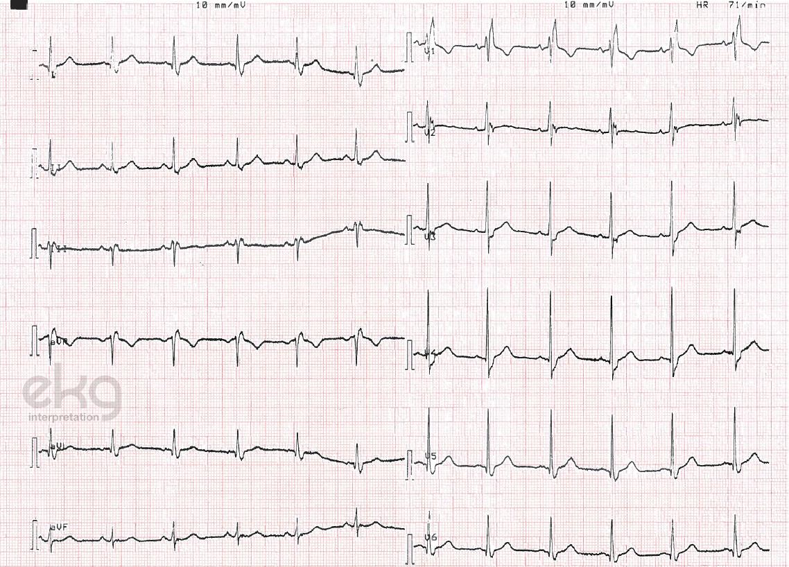 My medical blog: Belajar EKG