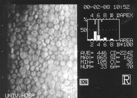 Saiba mais sobre a Distrofia de Fuchs - Portal da Oftalmologia
