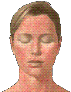 Patologias Virais: Rubéola