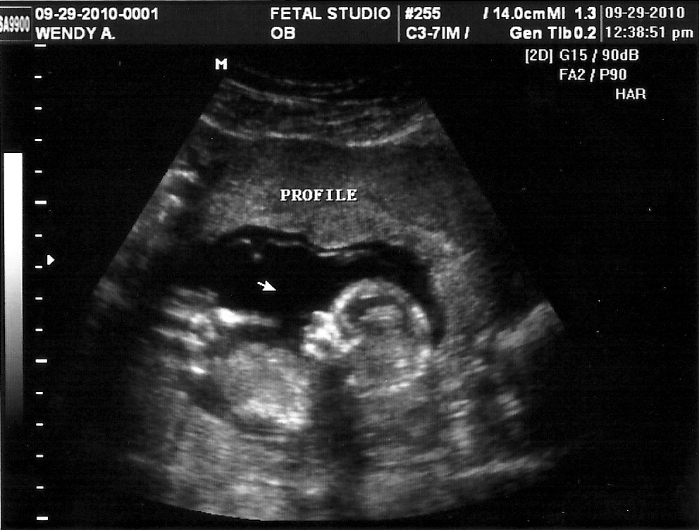 Sonogram At 14 Weeks