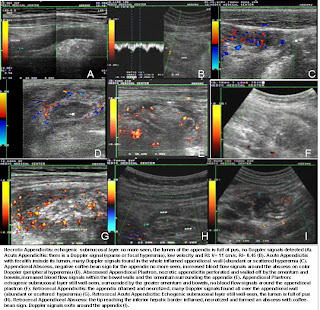 BS LÊ VĂN TÀI' S BLOG: COLOR DOPPLER DIAGNOSIS OF ACUTE APPENDICITIS
