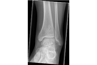 Sprunggelenksarthrose bei Osteochondrosis dissecans beider OSG ...