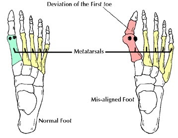 Gary and Kim's Blog: Bilateral Bunionectomy with Double Osteotomy with ...