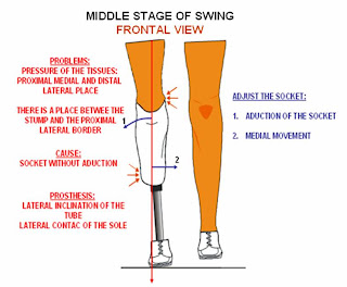 osteo support: TRANS-TIBIAL DYNAMIC ALIGNMENT