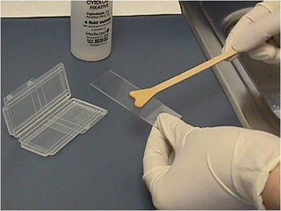 Cervarix -The Medical Revolution: Thin Prep Pap Smear