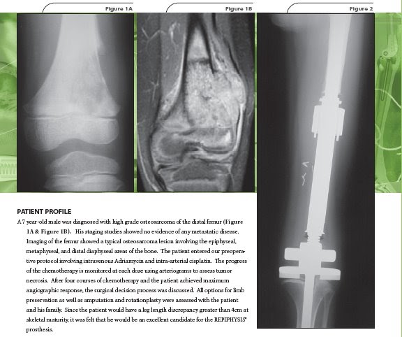 REHABILITACIÓN Y MEDICINA FÍSICA. Mirando al futuro.: Protesis para ...